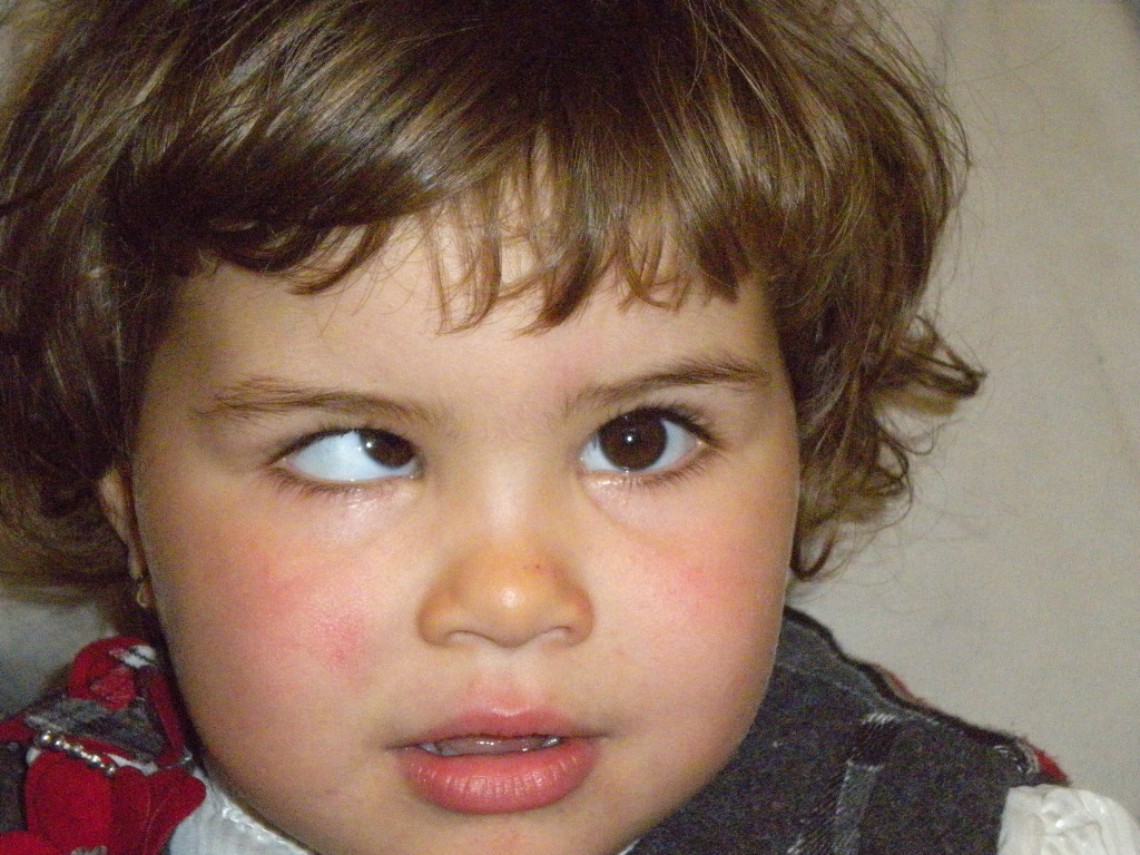 Strabisme | Cabinet d'Ophtalmologie du Dr Elgolli