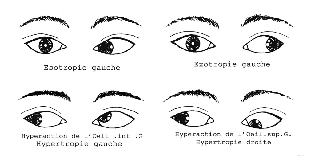 Strabisme | Cabinet d'Ophtalmologie du Dr Elgolli