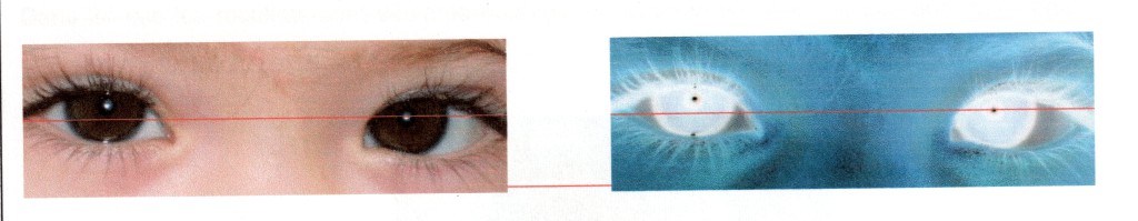 Strabisme | Cabinet d'Ophtalmologie du Dr Elgolli